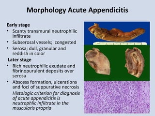 IBD and appendicitis | PPT | Digestive Disorders | Diseases and Conditions