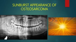 Lec 3 non odntogenic tumors and tumor like lesions of orofacial region ...
