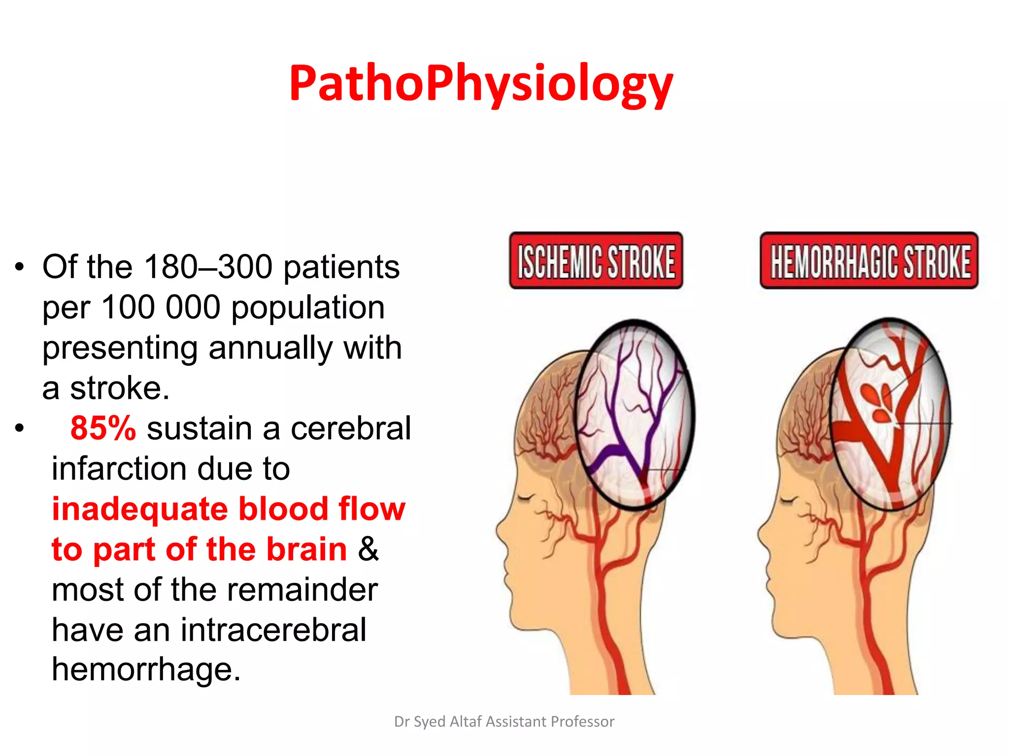 Stroke & its Management ( Medicine) | PPTX