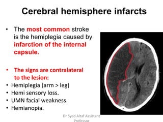Stroke & its Management ( Medicine) | PPTX