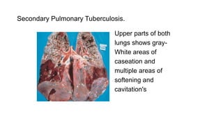 Lec 3 tuberculosis 3 | PPTX