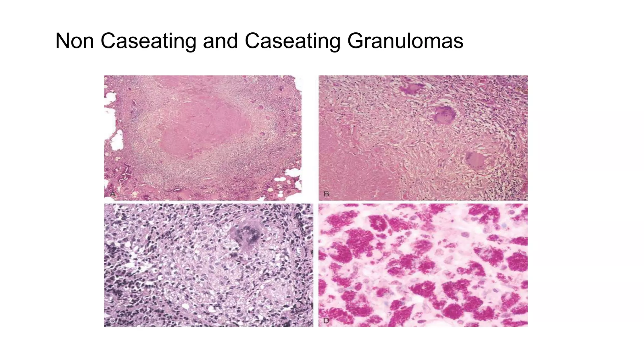 Tuberculosis & Leprosy | PPTX