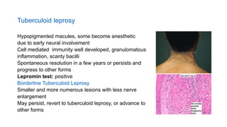 Tuberculosis & Leprosy | PPTX