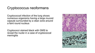 Fungal infections | PPTX