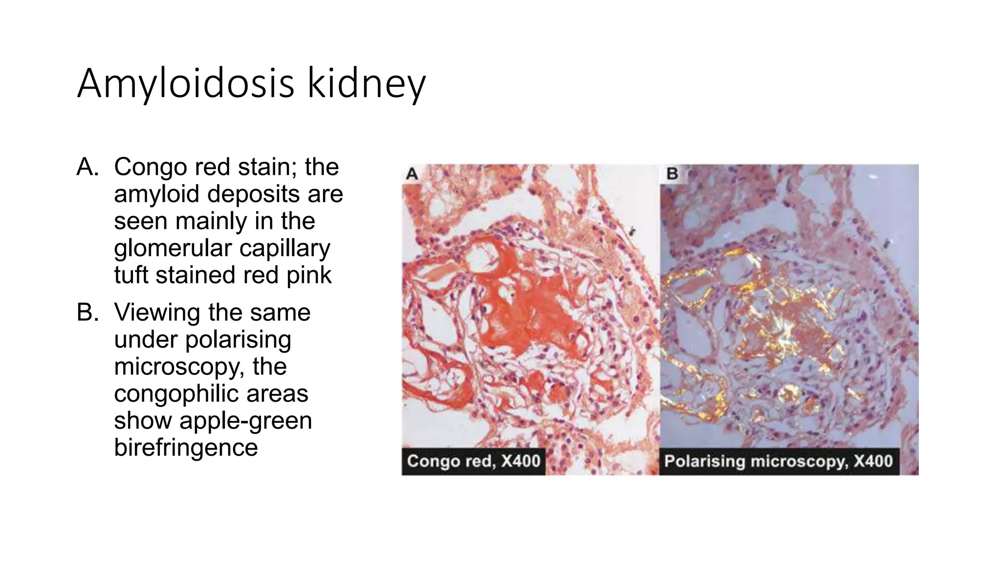 Amyloidosis | PPTX