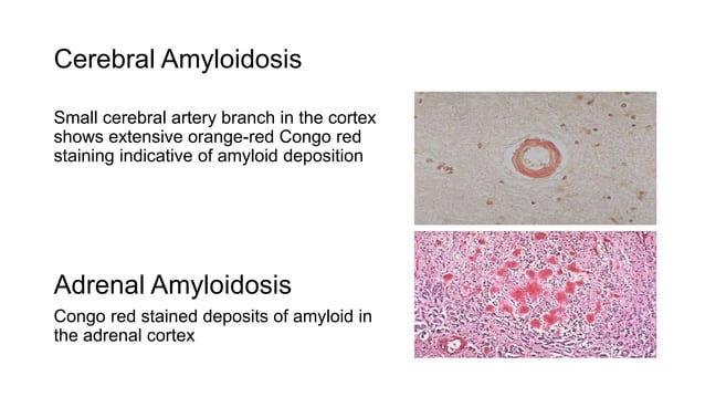 Amyloidosis | PPTX | Chemistry | Science