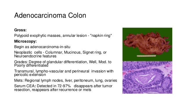 Intestinal neoplasm