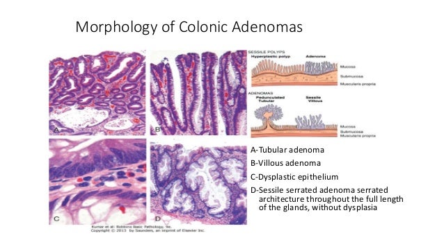 Intestinal neoplasm