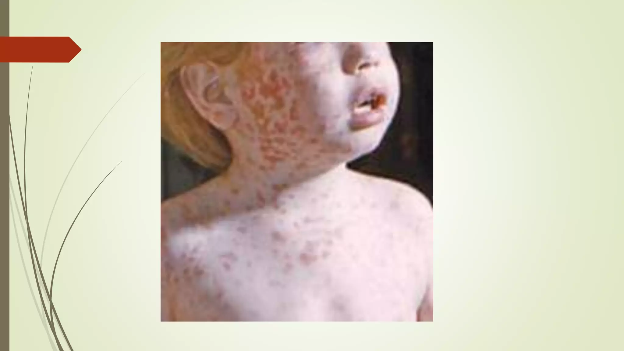Lec4 measles, mumps, rubella, small pox & ulcer | PPT