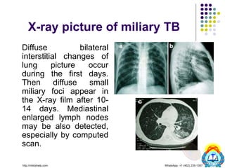 Lec 5.pdf tuberculosis miliary tuberculosis meningitis | PPT
