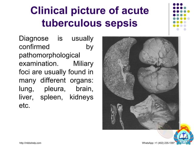 Lec 5.pdf tuberculosis miliary tuberculosis meningitis | PPT