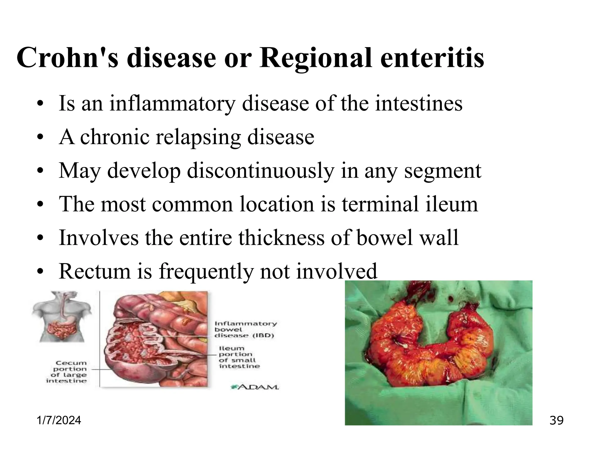 Lec # 5 Disorders of small & large Intestine.ppt