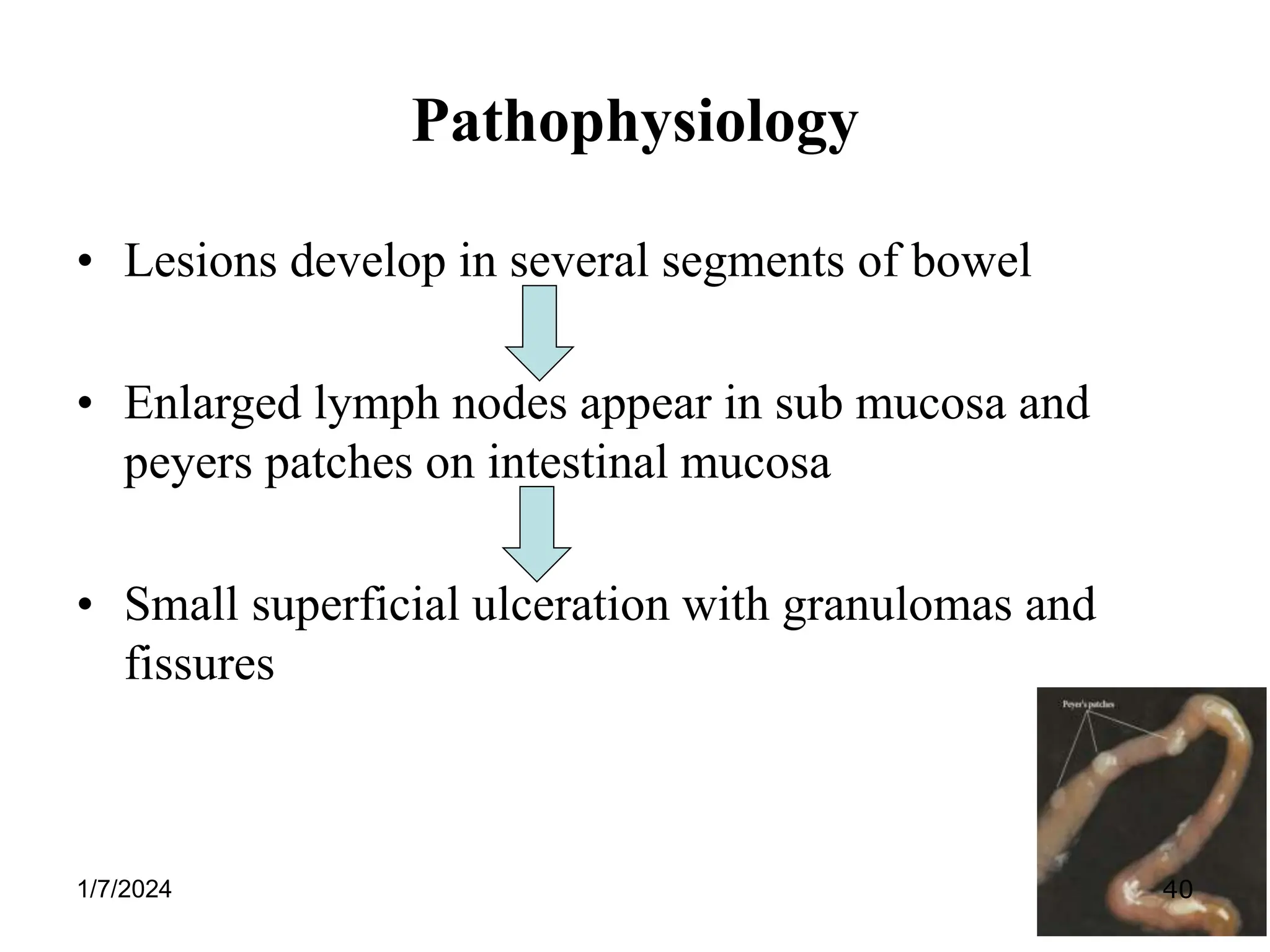 Lec # 5 Disorders of small & large Intestine.ppt