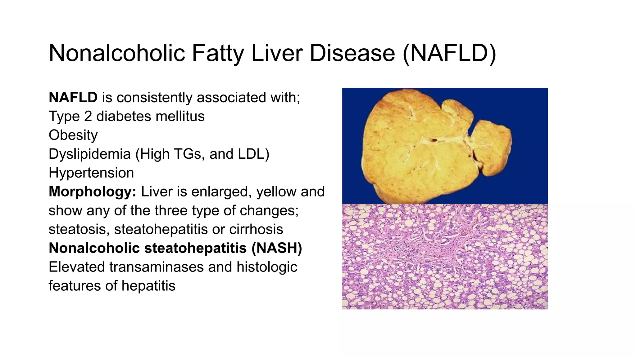 Inflammatory liver disease | PPTX
