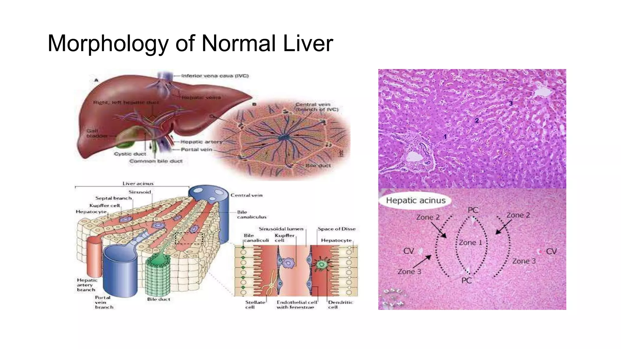 Inflammatory liver disease | PPTX