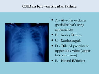 Lec 5 management of heart failure for mohs | PPTX