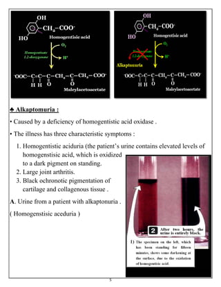 PhenylKetonuria & Alkaptomuria & Albinism & Cystinuria & Maple Syrup ...