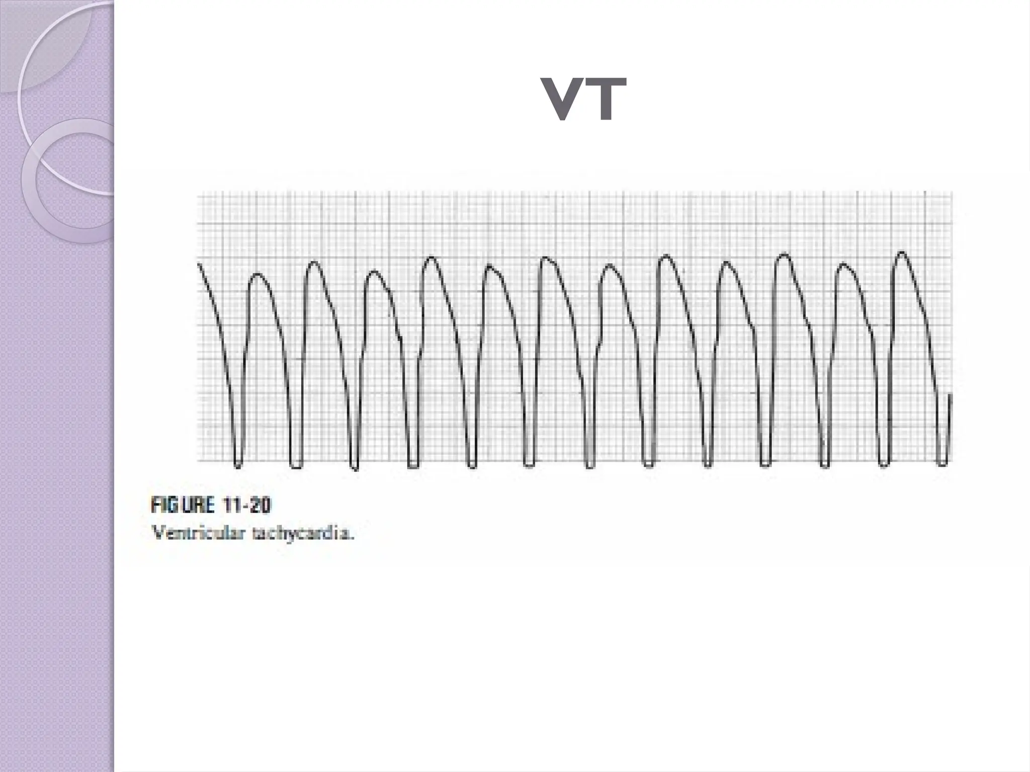 Lec 6 ECG.pptx cardiopulmonary physical therapy | PPTX