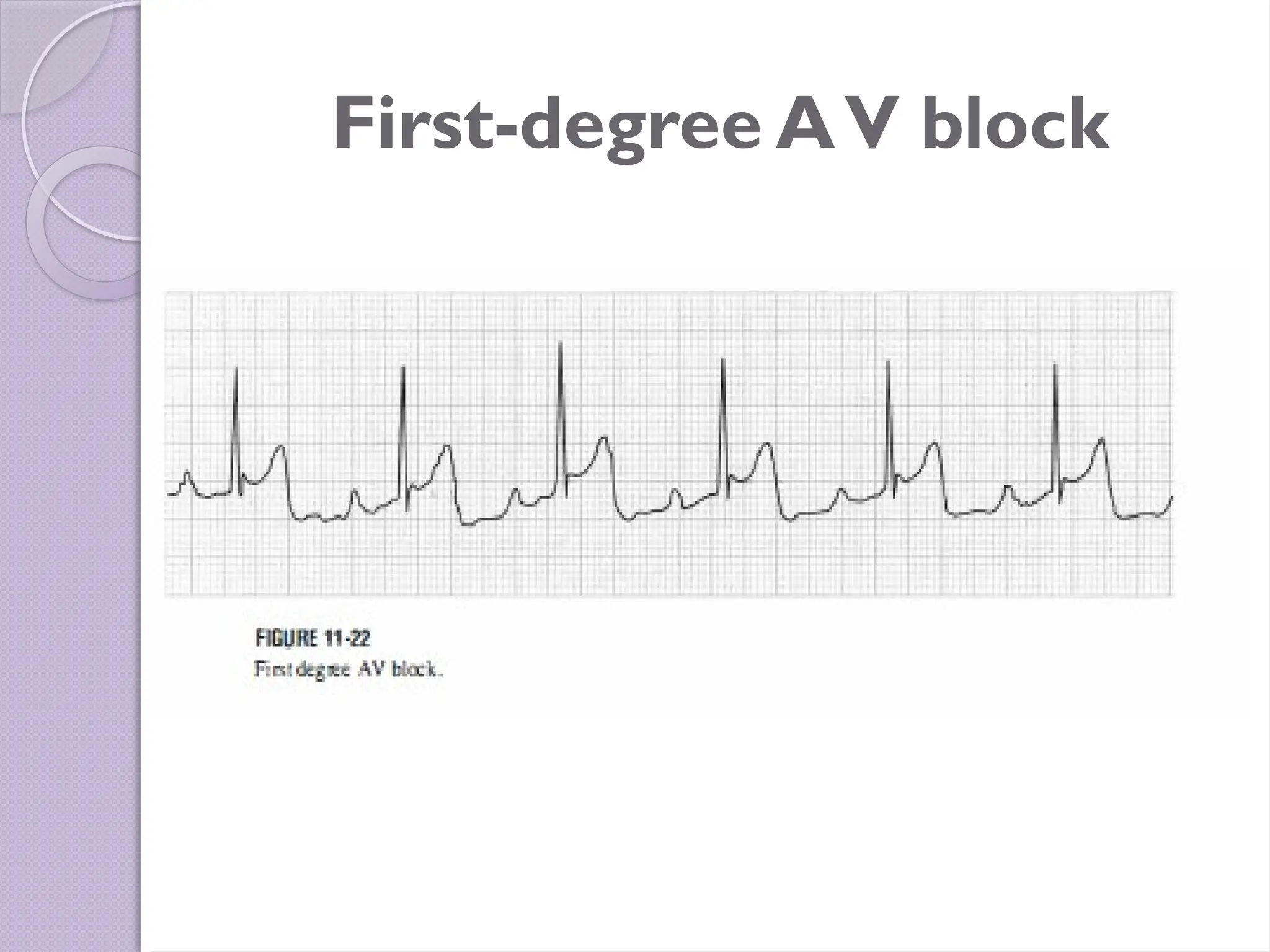 Lec 6 ECG.pptx cardiopulmonary physical therapy | PPTX