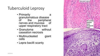 Lec 6 leprosy | PPT