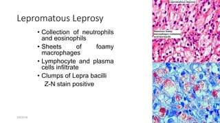 Lec 6 leprosy | PPT