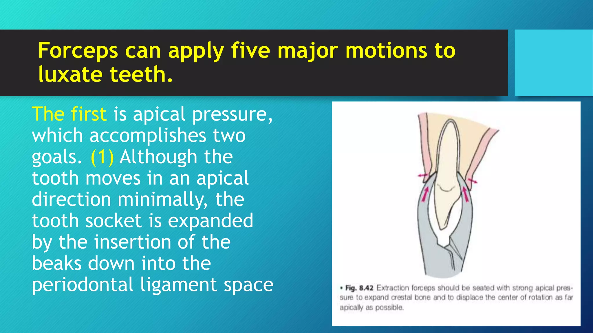 Mechanical Principles Involved in Tooth Extraction 1 | PPTX