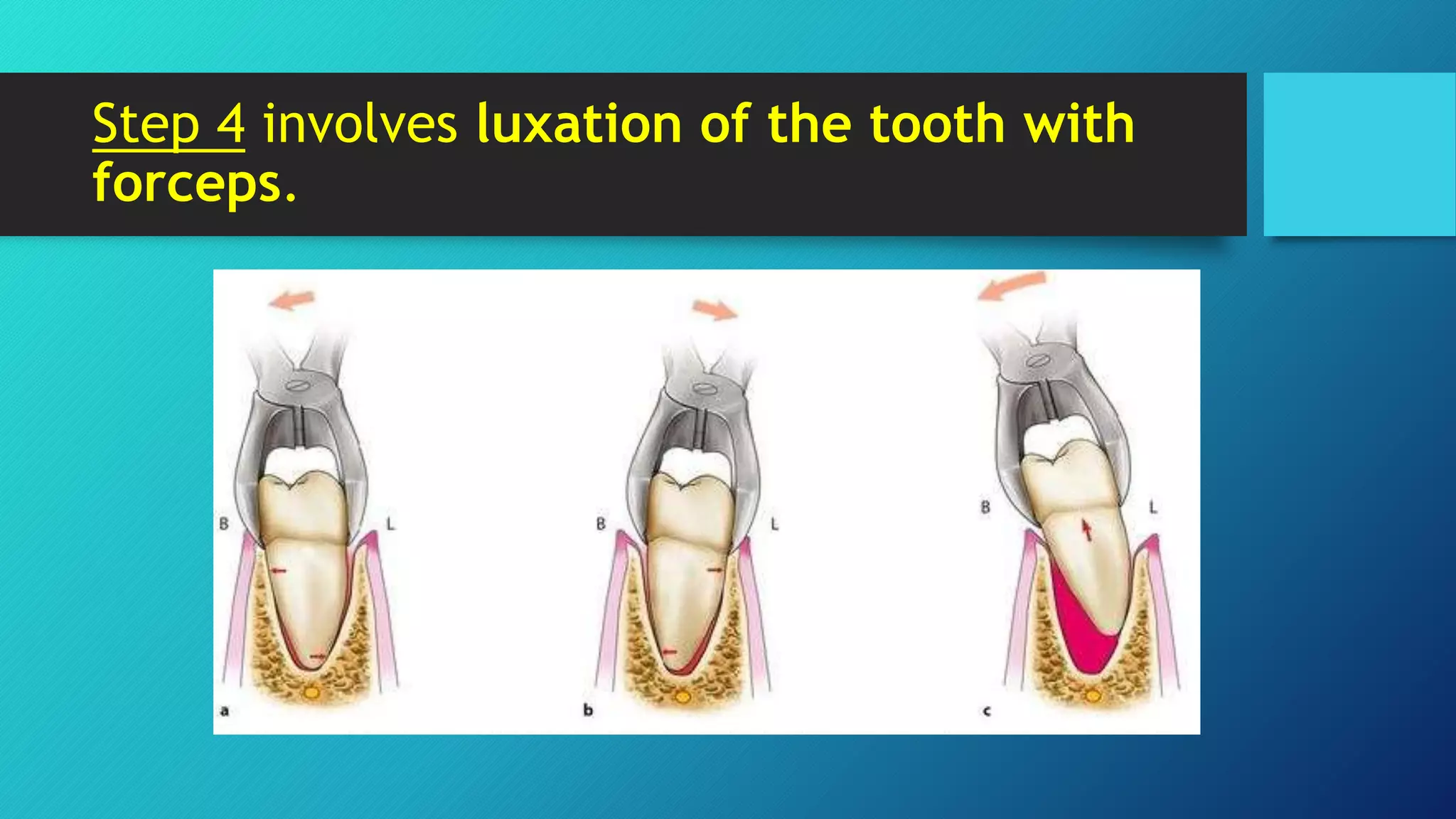 Mechanical Principles Involved in Tooth Extraction 1 | PPTX