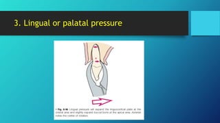 Mechanical Principles Involved in Tooth Extraction 1 | PPTX