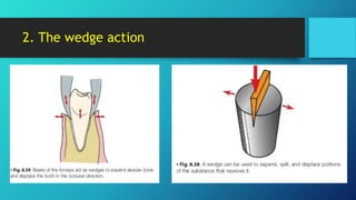 Mechanical Principles Involved in Tooth Extraction 1 | PPTX