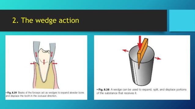 Mechanical Principles Involved in Tooth Extraction 1 | PPTX | Dental ...