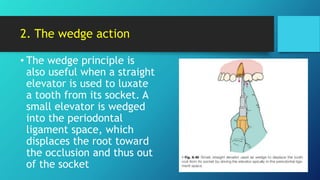 Mechanical Principles Involved in Tooth Extraction 1 | PPTX