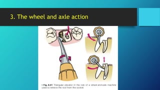 Mechanical Principles Involved in Tooth Extraction 1 | PPTX