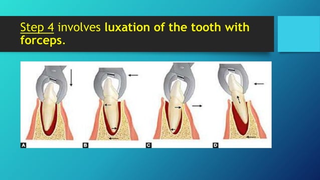 Mechanical Principles Involved in Tooth Extraction 1
