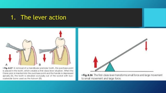 Mechanical Principles Involved in Tooth Extraction 1