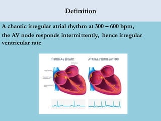 Lec 8 atrial fibrillation for mohs | PPTX