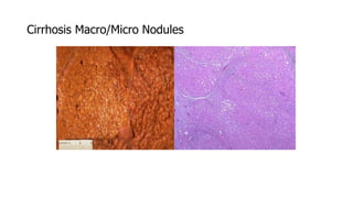 Cirrhosis of liver | PPT