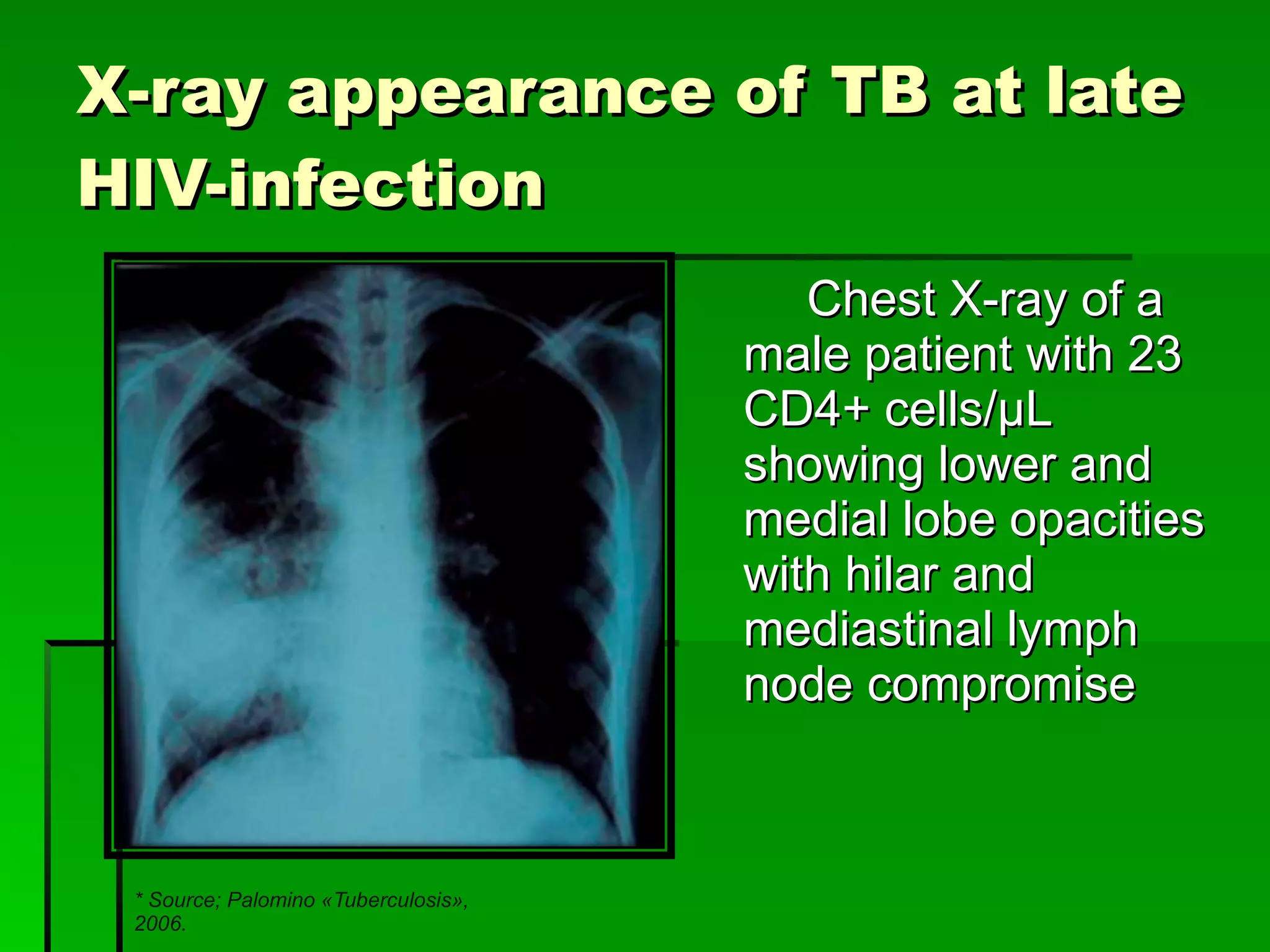 Hiv in tuberculosis | PDF