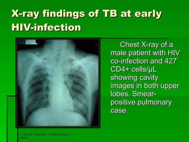 Hiv in tuberculosis | PDF