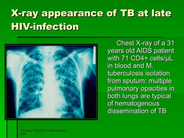 Hiv in tuberculosis | PDF