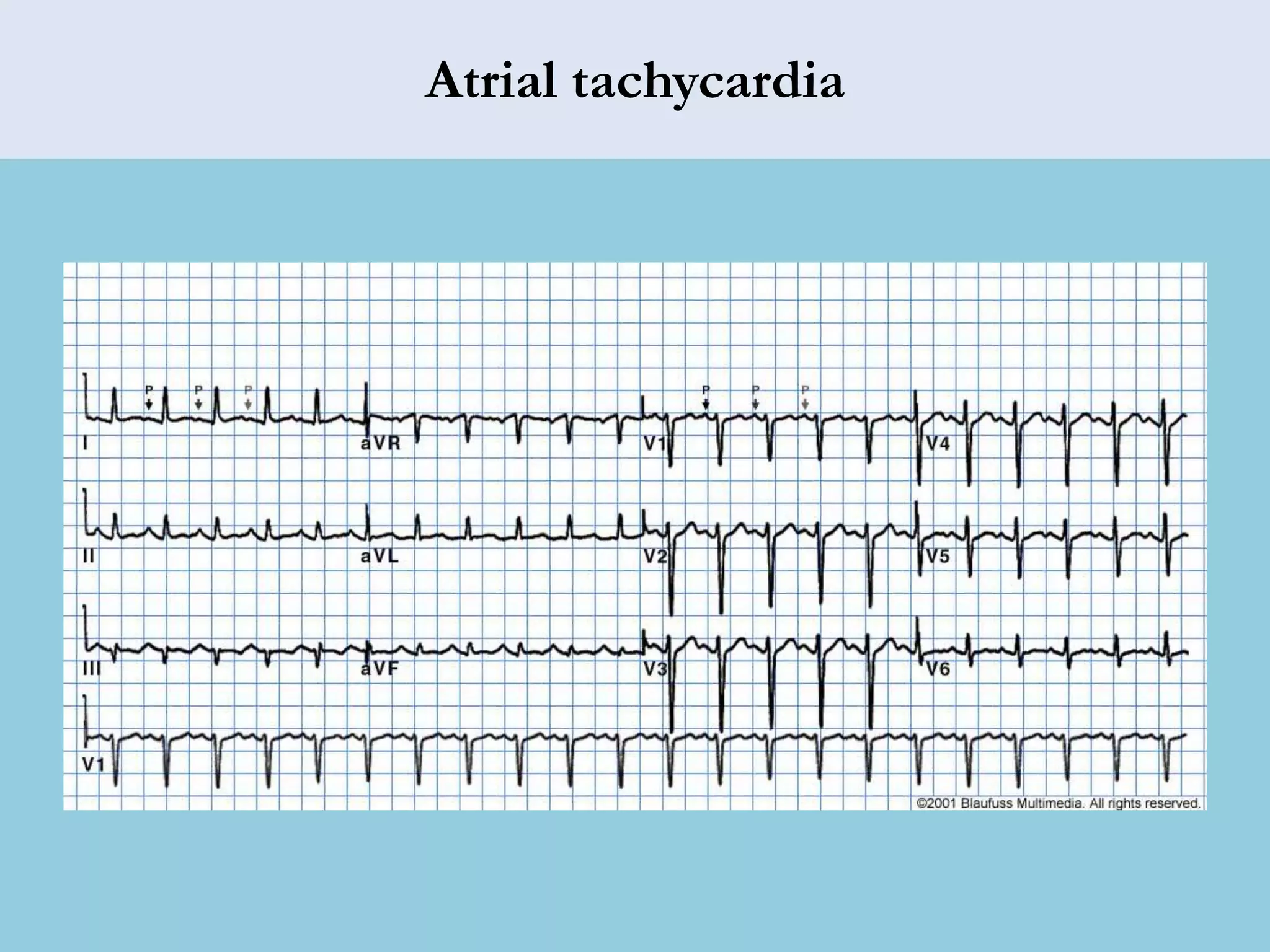 Lec 9 narrow complex wide complex tachycardia for mohs | PPTX | Heart ...