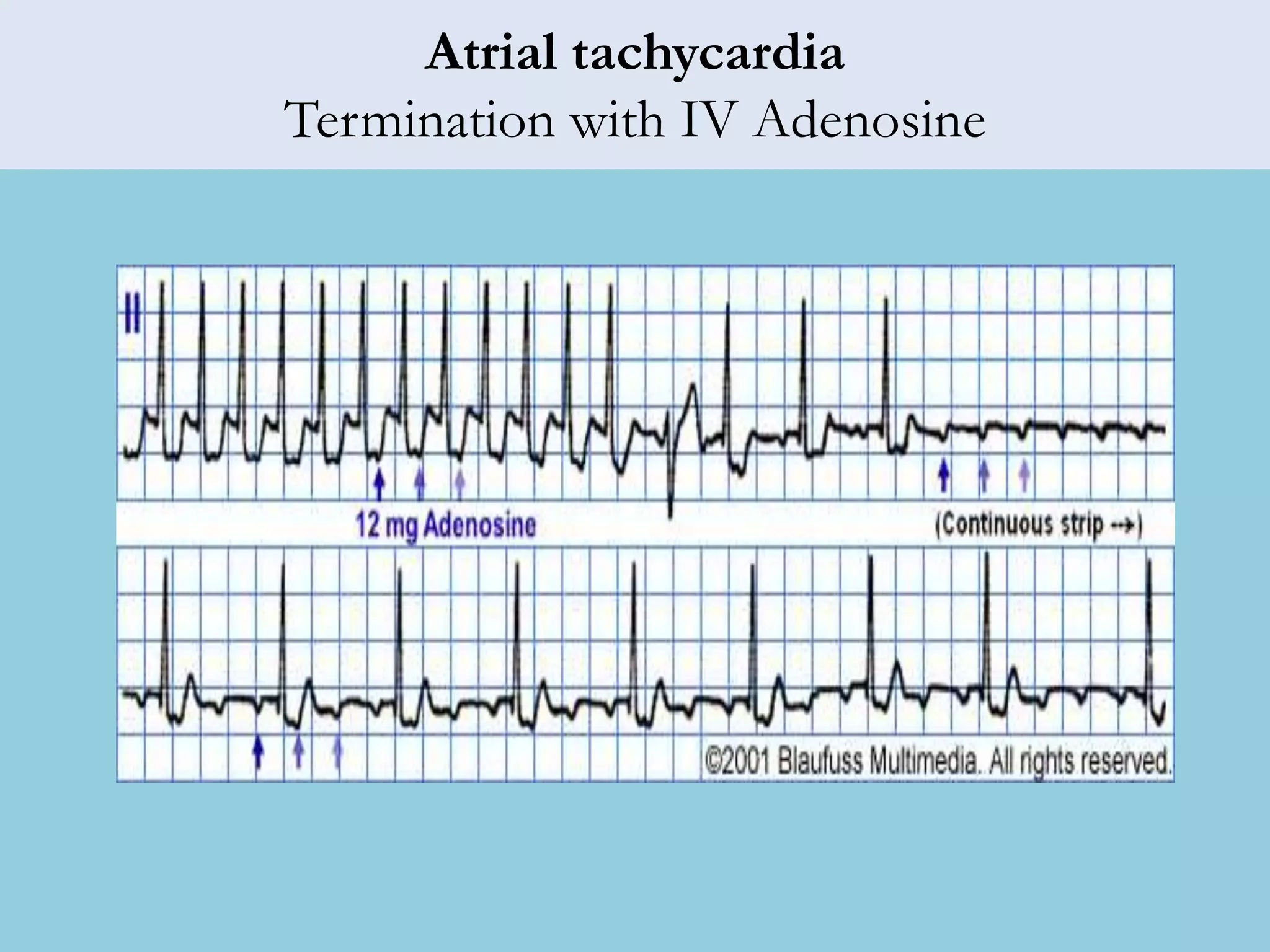 Lec 9 narrow complex wide complex tachycardia for mohs | PPTX | Heart ...