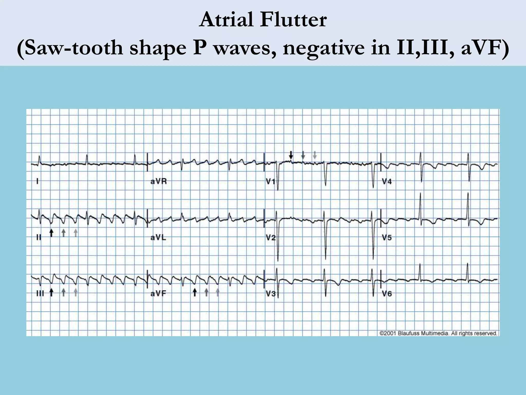 Lec 9 narrow complex wide complex tachycardia for mohs | PPTX | Heart ...