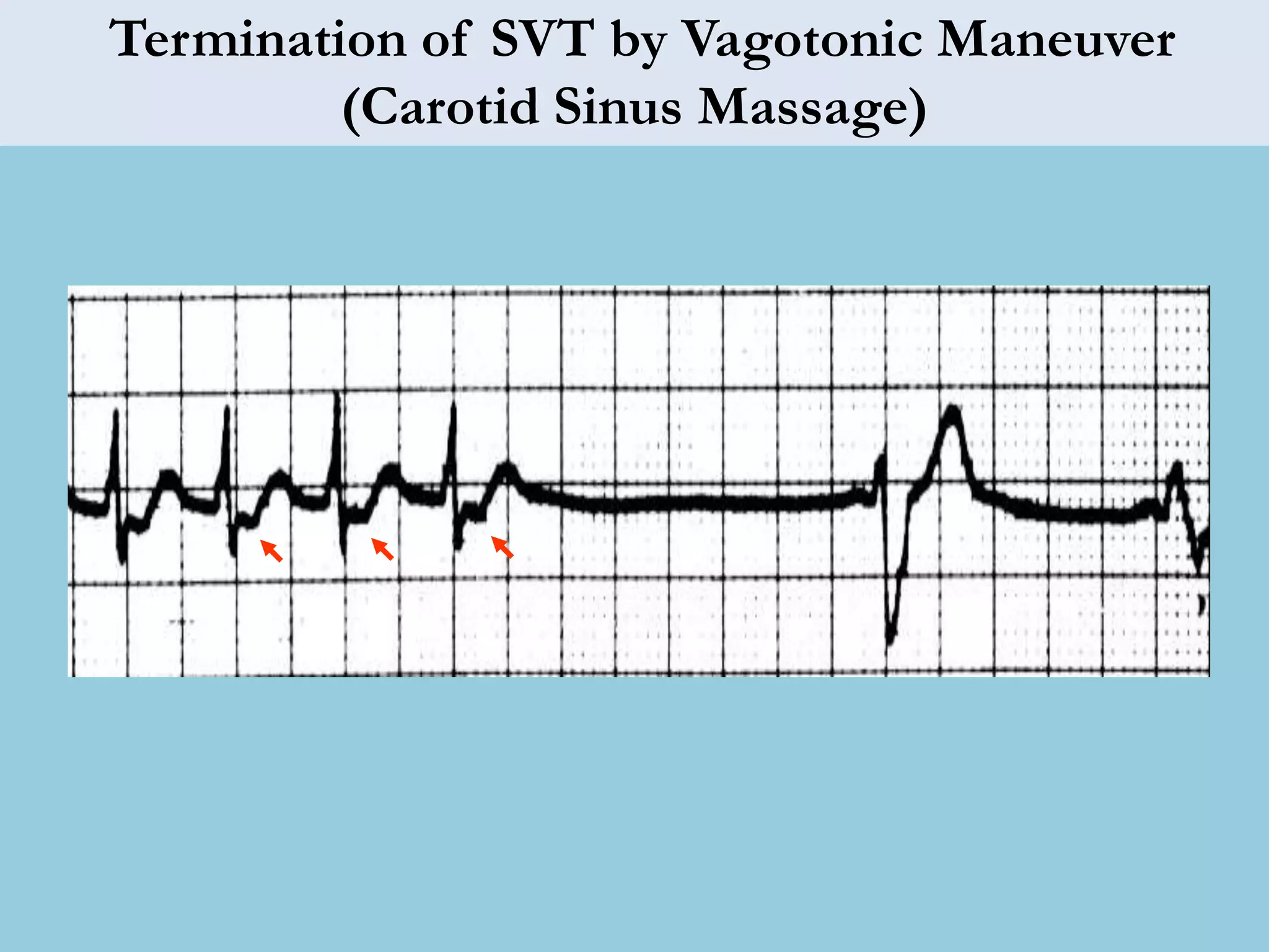 Lec 9 narrow complex wide complex tachycardia for mohs | PPTX | Heart ...