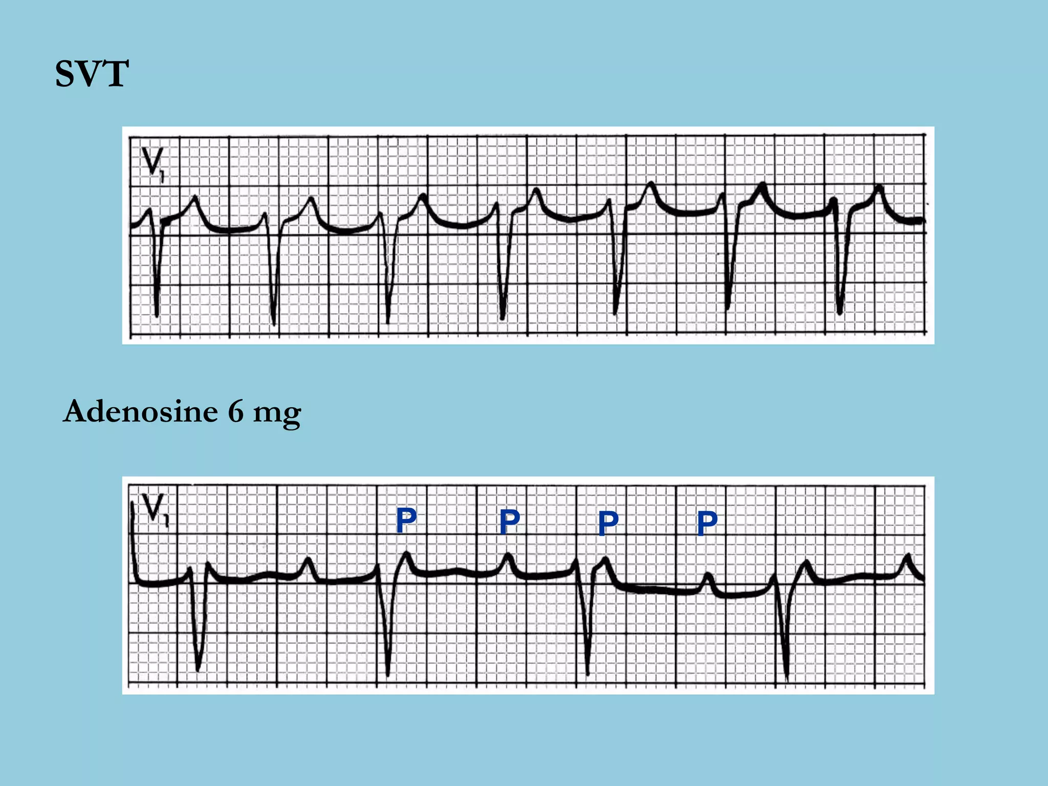 Lec 9 narrow complex wide complex tachycardia for mohs | PPTX | Heart ...