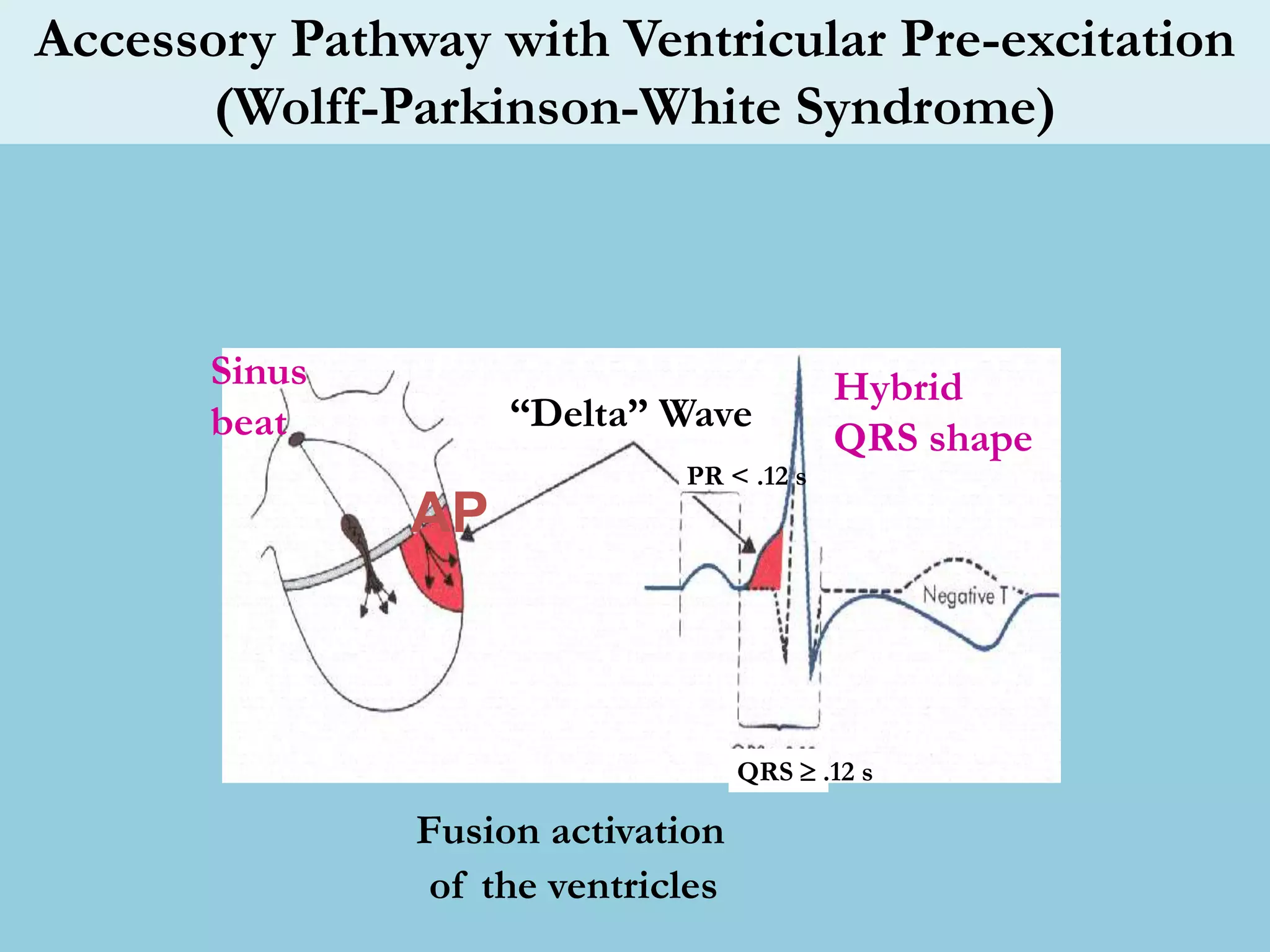 Lec 9 narrow complex wide complex tachycardia for mohs | PPTX | Heart ...