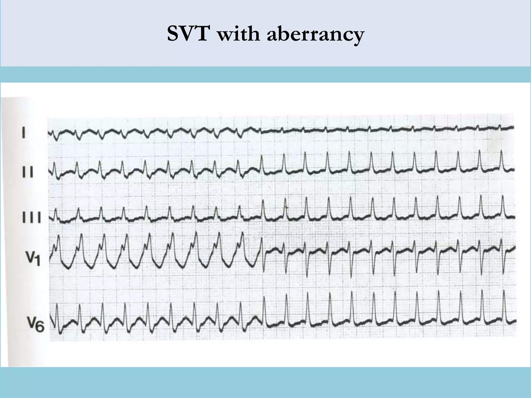 Lec 9 narrow complex wide complex tachycardia for mohs | PPTX | Heart ...