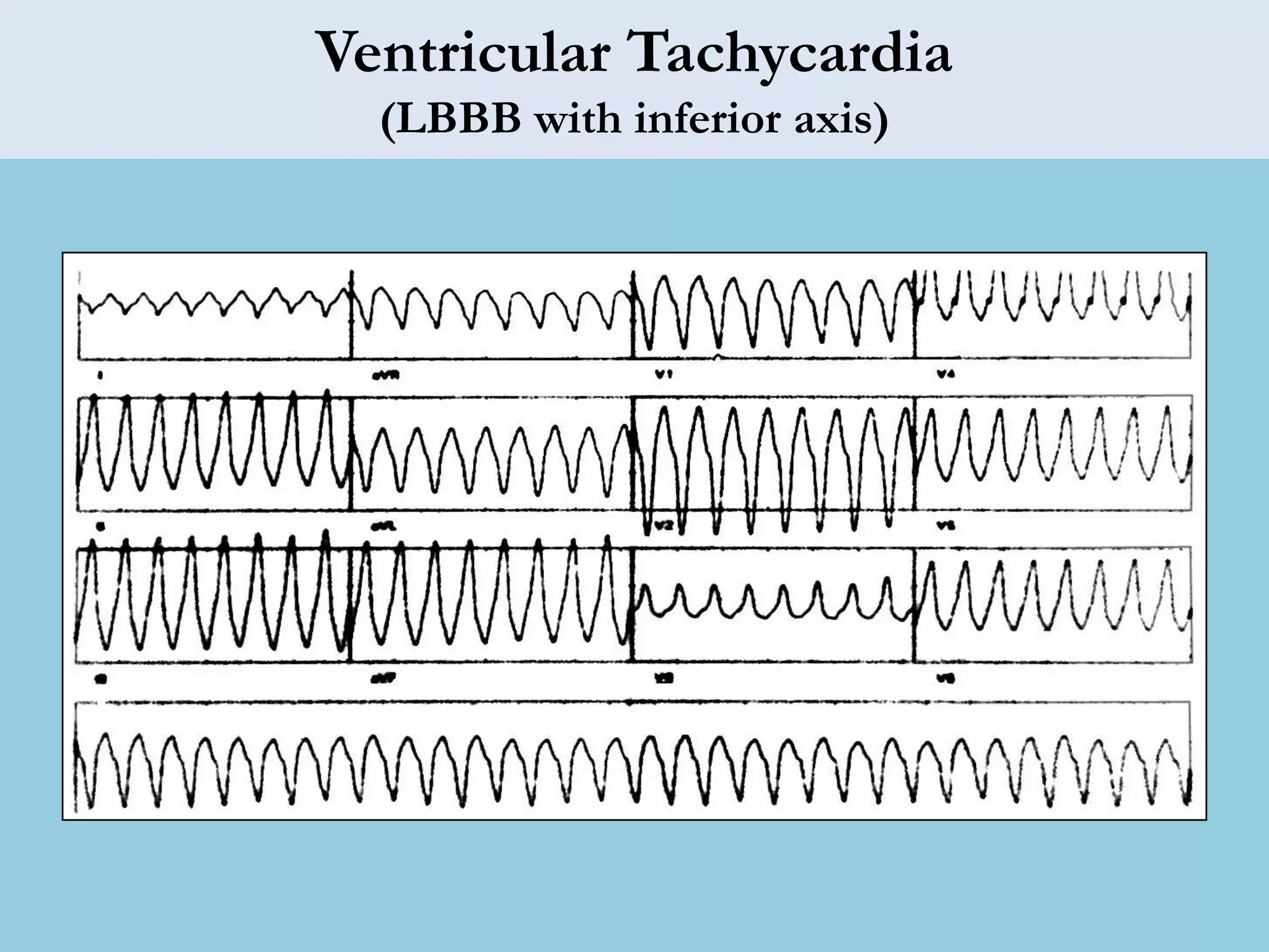 Lec 9 narrow complex wide complex tachycardia for mohs | PPTX | Heart ...