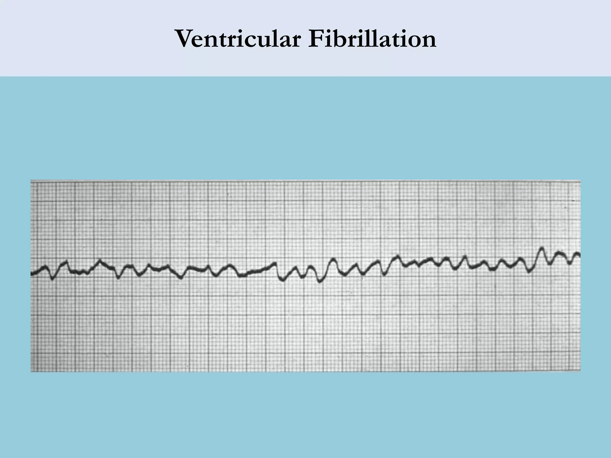 Lec 9 narrow complex wide complex tachycardia for mohs | PPTX | Heart ...
