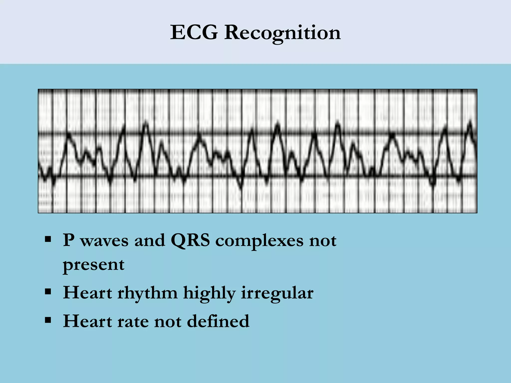 Lec 9 narrow complex wide complex tachycardia for mohs | PPTX | Heart ...