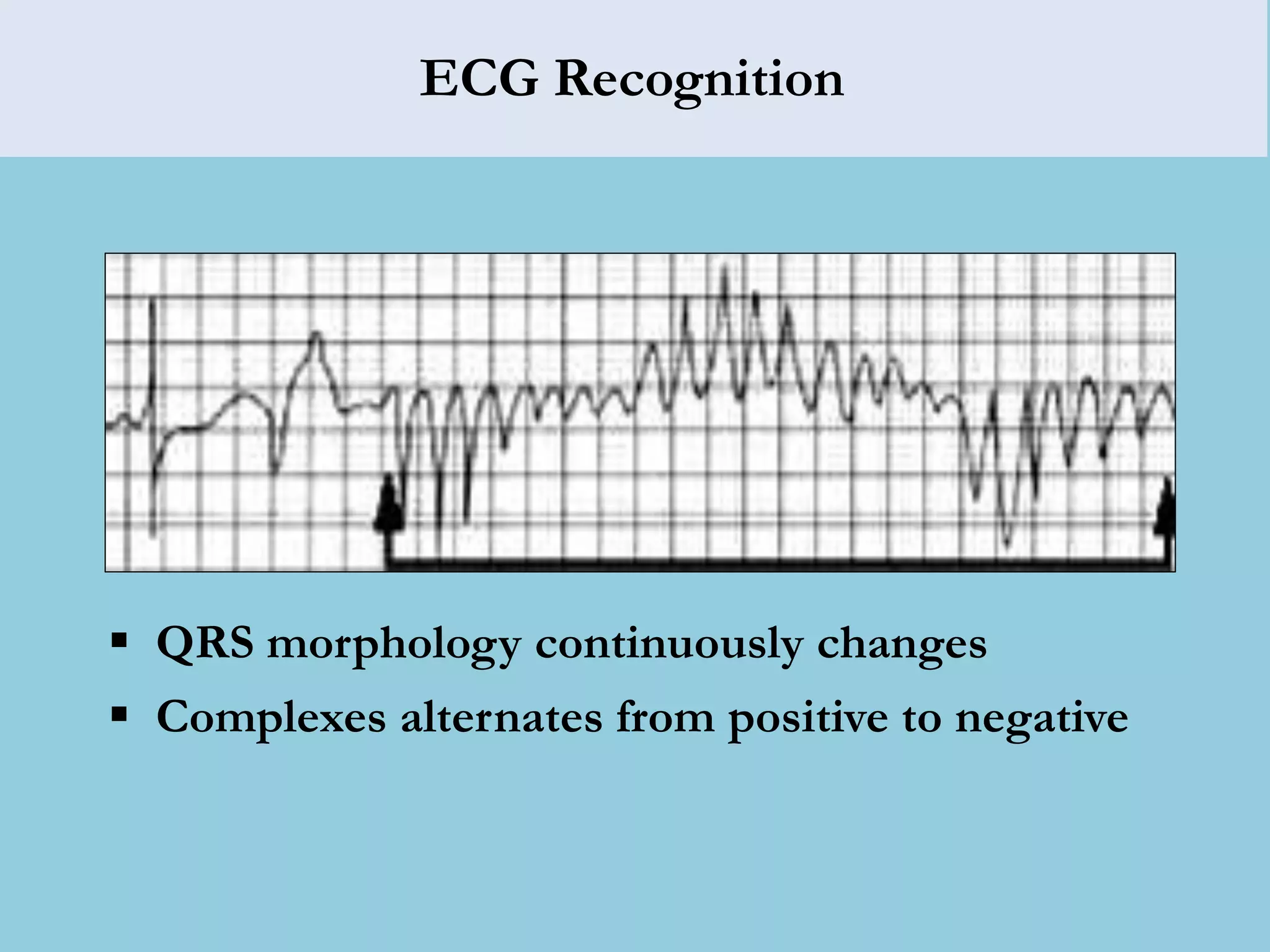 Lec 9 narrow complex wide complex tachycardia for mohs | PPTX | Heart ...